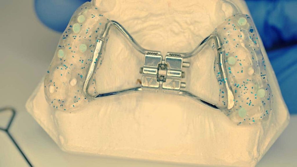 Palatal Expander Device (PED) – Children's Dental Associates of New ...